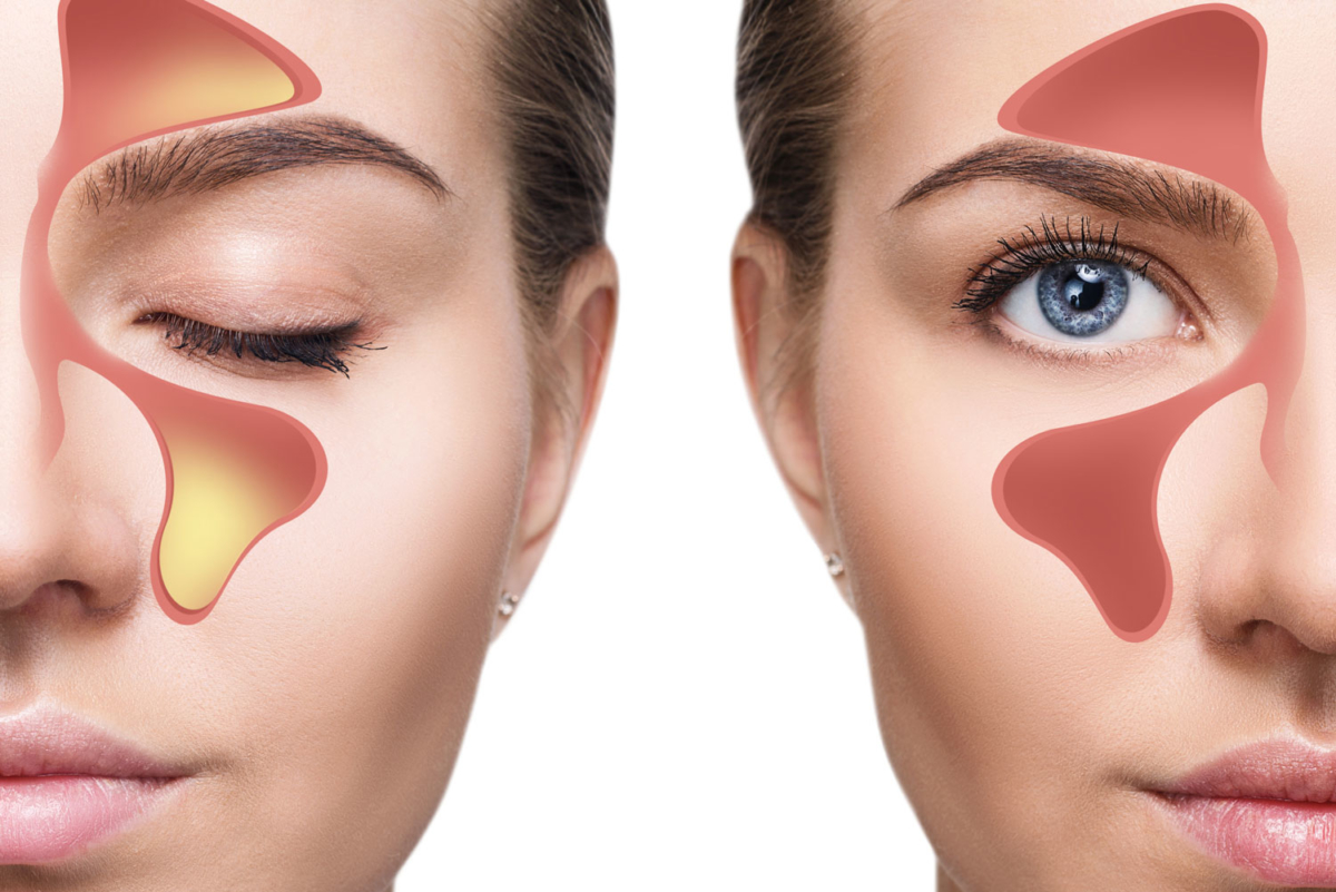 Revision Rhinoplasty with Balloon Sinuplasty the Total Nose Approach ...