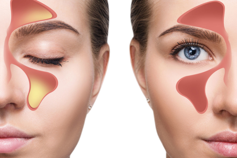 Revision Rhinoplasty with Balloon Sinuplasty the Total Nose Approach ...